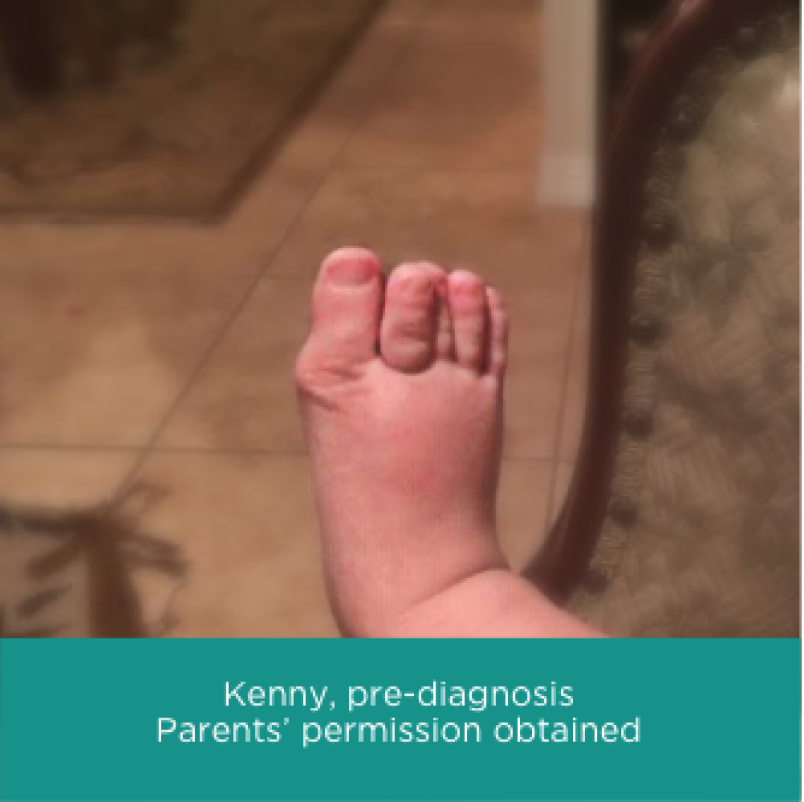 What is FOP? - Focus on FOP HCP